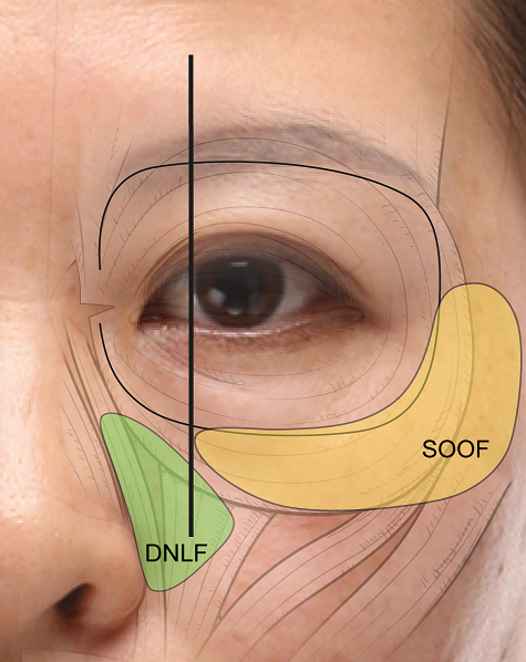 [안티에이징 대백과] "동안 위해 찾는 '하안검수술'…가능 여부 먼저 따져봐야"